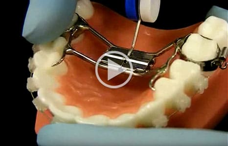 Ann Arbor Orthodontist Treatment Video Education for Braces